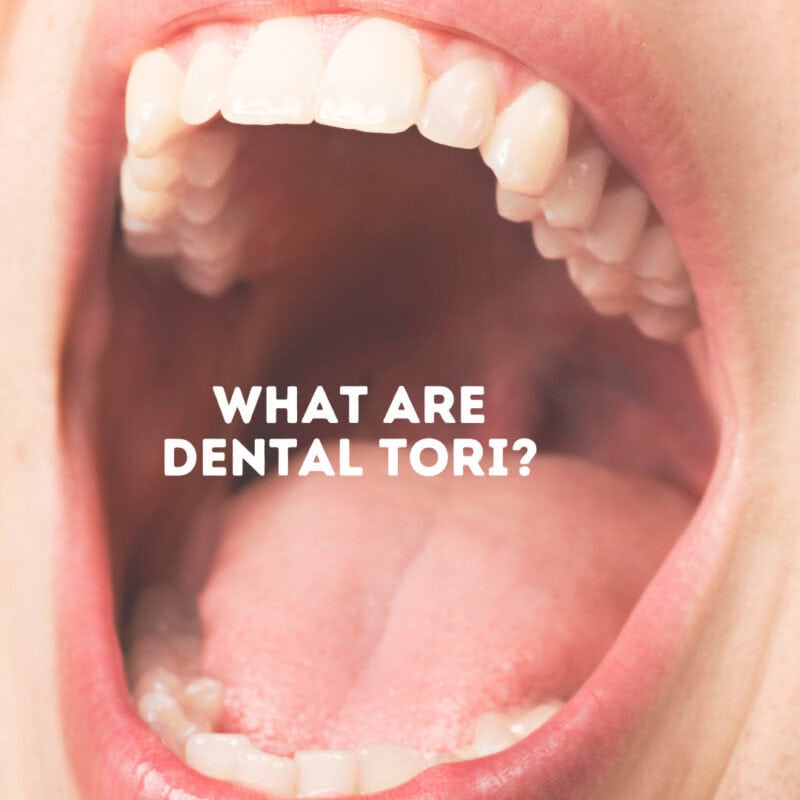 What is Mandibular Tori? - Mid-State Oral Surgery and Implant Center